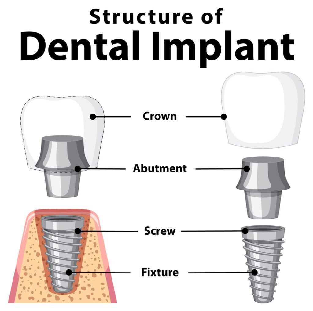 Best Dental Implant Companies 2025: Ranked & Reviewed - Kristal Clinic
