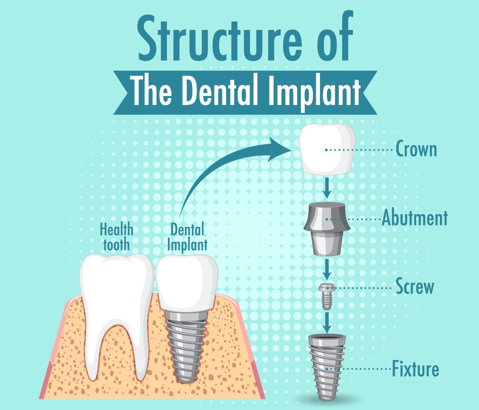 Dental Implant Parts Explained Simply: The 3 Key Pieces - Kristal Clinic