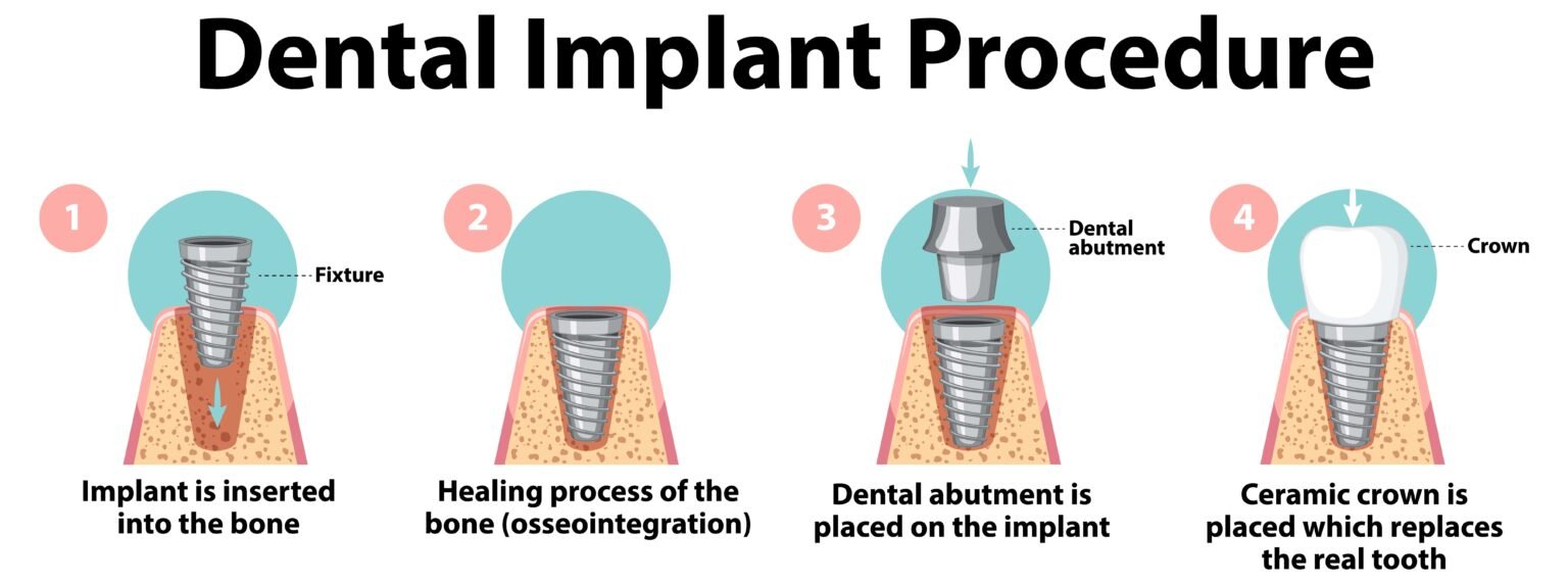 Dental Implant Parts Explained Simply: The 3 Key Pieces - Kristal Clinic